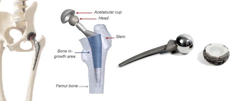 How YICHOU Sets the Standard in Implant Manufacturing – Orthopedic and ...