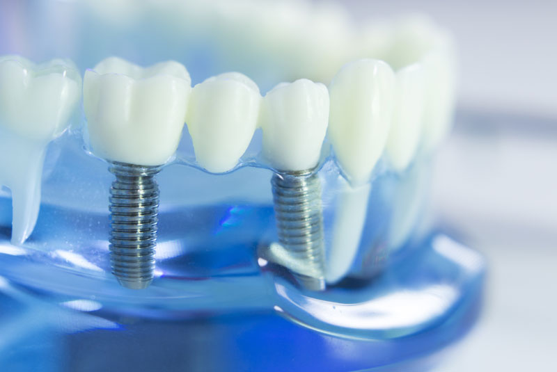 The Ultimate Guide to Titanium Implants: Enhance Your Smile and Restore ...